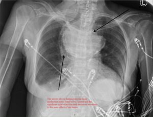 Mediastinal Mass. CXR. Annotated. JETem 2021 - JETem