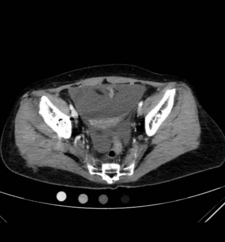 An Atraumatic, Idiopathic Case Report of Intraperitoneal Bladder Dome ...