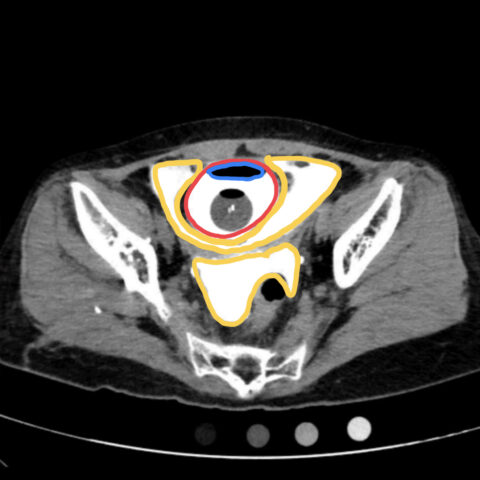 An Atraumatic, Idiopathic Case Report of Intraperitoneal Bladder Dome ...