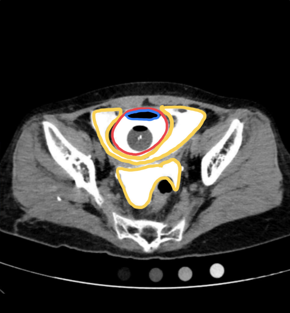 Bladder Rupture. CT Contrast Axial Annotated. JETem 2021 - JETem