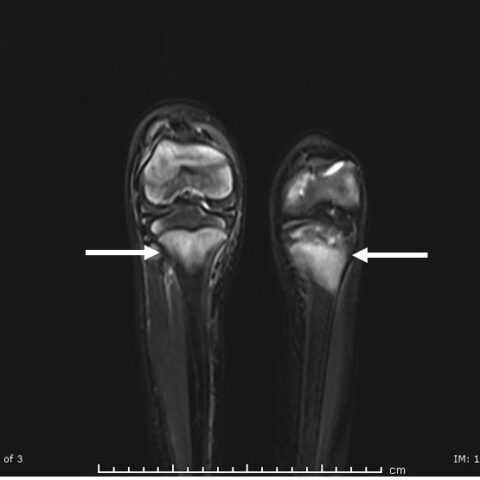 A Boy with Rash and Joint Pain Diagnosed with Scurvy: A Case Report - JETem