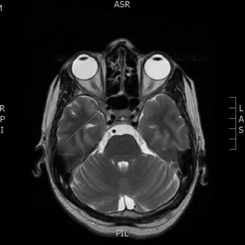 Case Report of a Man with Right Eye Pain and Double Vision - JETem