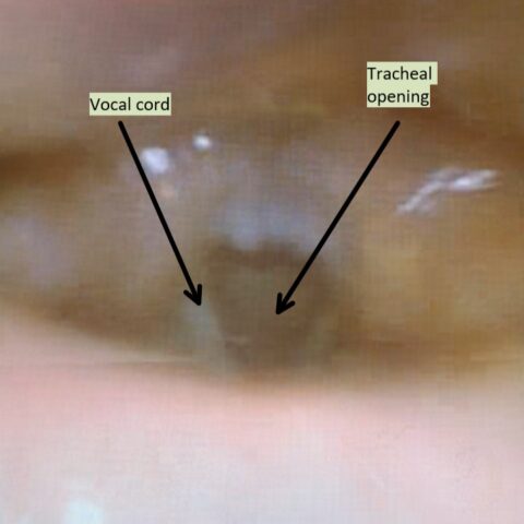 Evaluation of ACE-inhibitor Induced Laryngeal Edema Using Fiberoptic ...
