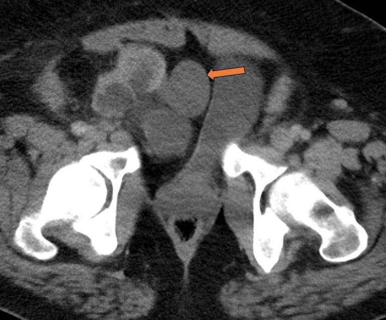 Pelvic Kidney with Ureteral Obstruction from Inguinal Hernia Entrapment ...