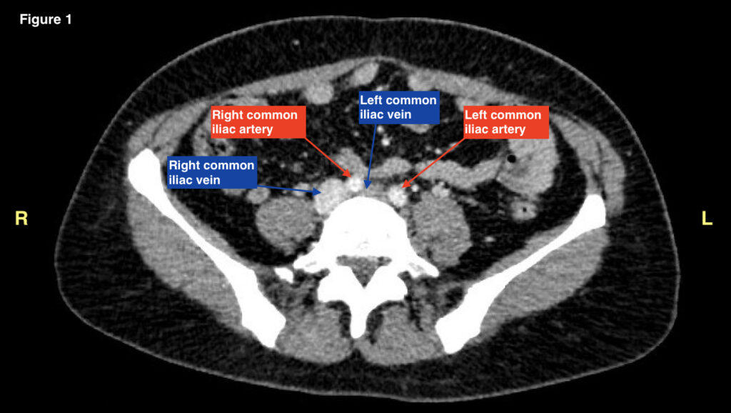 May Thurner. CTA of the pelvis, transverse image, Annotated. JETem 2022 ...