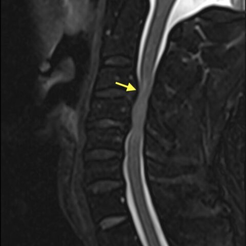 A Case Report of a Man with Burning Arm and Leg Weakness - JETem