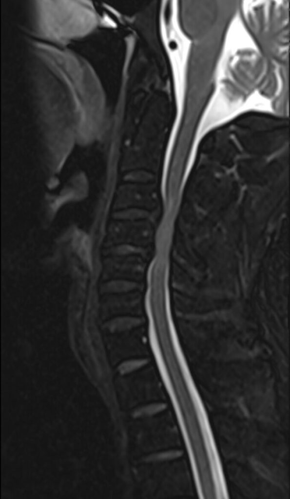 A Case Report of a Man with Burning Arm and Leg Weakness – JETem