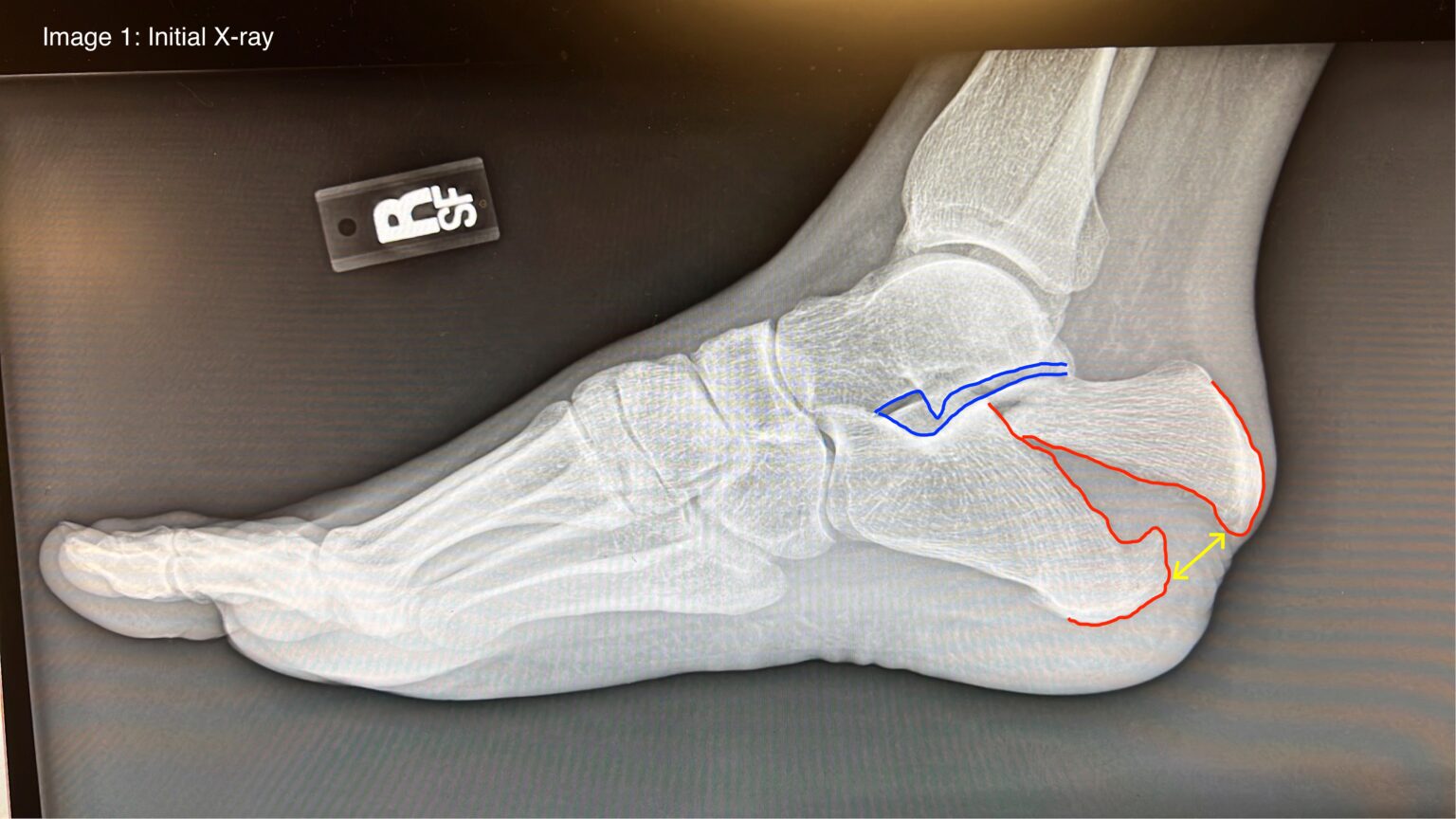 Tongue-Type Calcaneal Fracture Image 1 Lateral XR Annotated - JETem