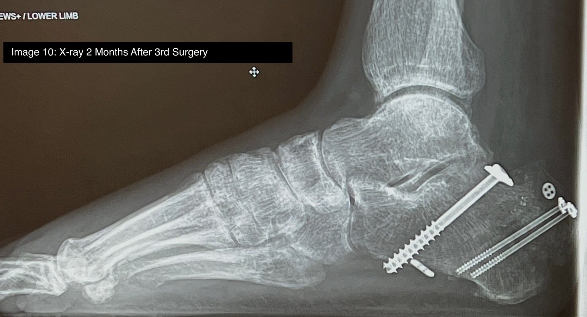 Tongue-Type Calcaneal Fracture Image 10 Annotated - JETem