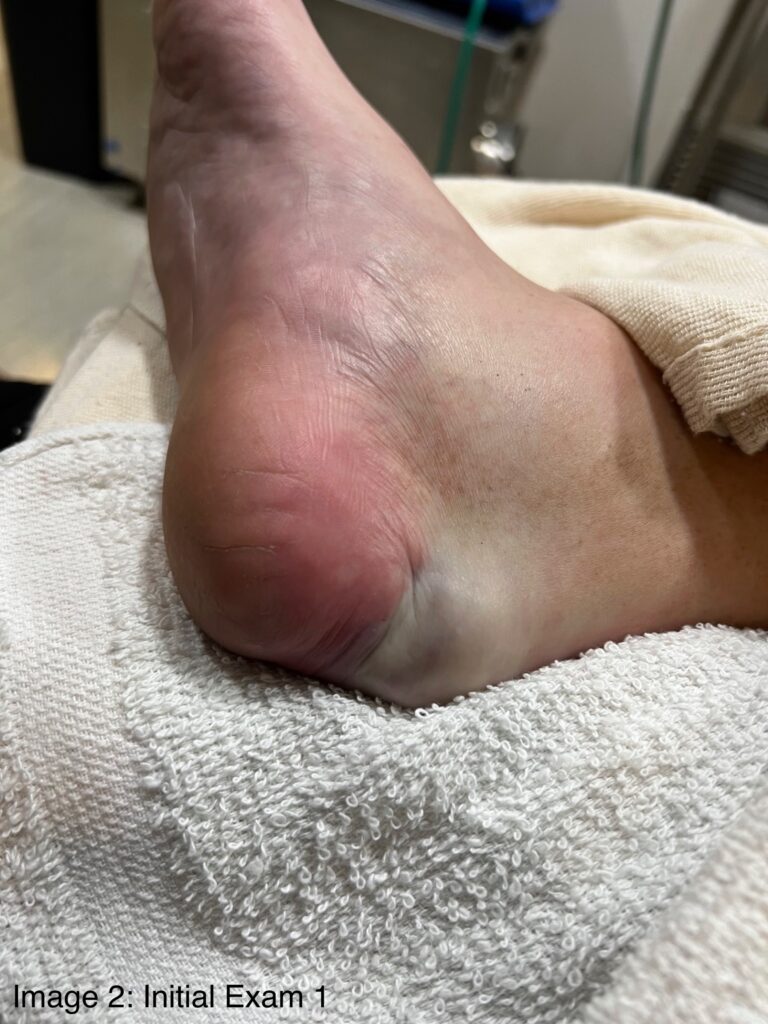 Tongue Type Calcaneal Fracture Image 2 Annotated Jetem
