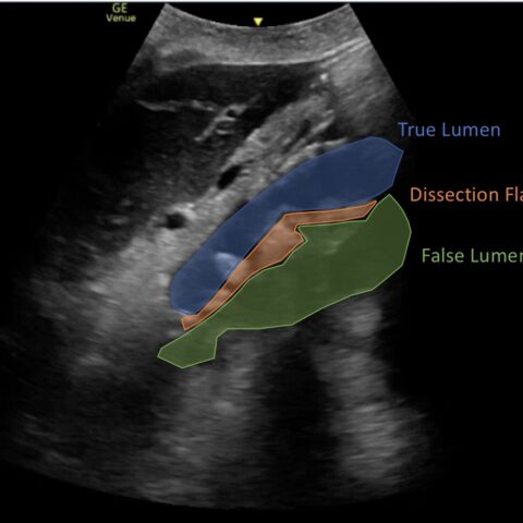 Aortic Dissection Case Report - JETem