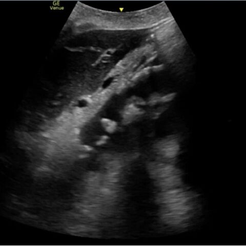 Aortic Dissection Case Report - JETem
