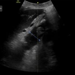 Aortic Dissection Case Report - JETem
