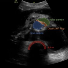 Aortic Dissection Case Report - JETem
