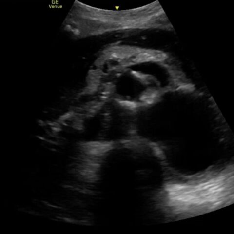 Aortic Dissection Case Report - JETem