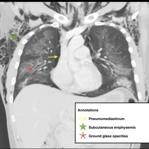 Electronic Cigarette or Vaping-Associated Lung Injury Case Report - JETem