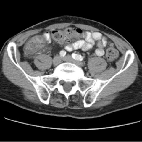 Imaging Findings of Small Bowel - Diverticulitis: A Case Report - JETem
