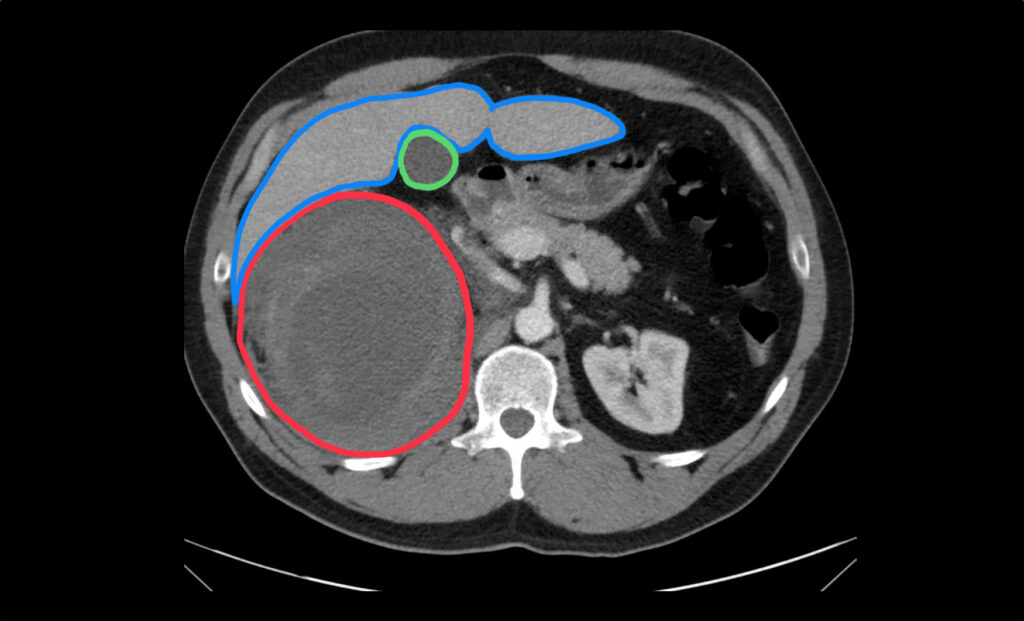 R Retroperitoneal Hematoma CT Annotated 1. JETem 2023 - JETem