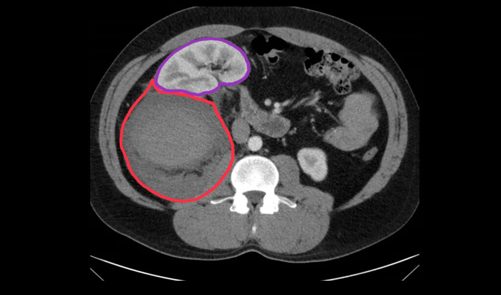 R Retroperitoneal Hematoma CT Annotated 2. JETem 2023 - JETem