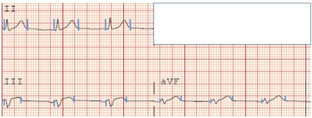 Type 1 MI. ECG, Annotated 2. JETem 2023 - JETem