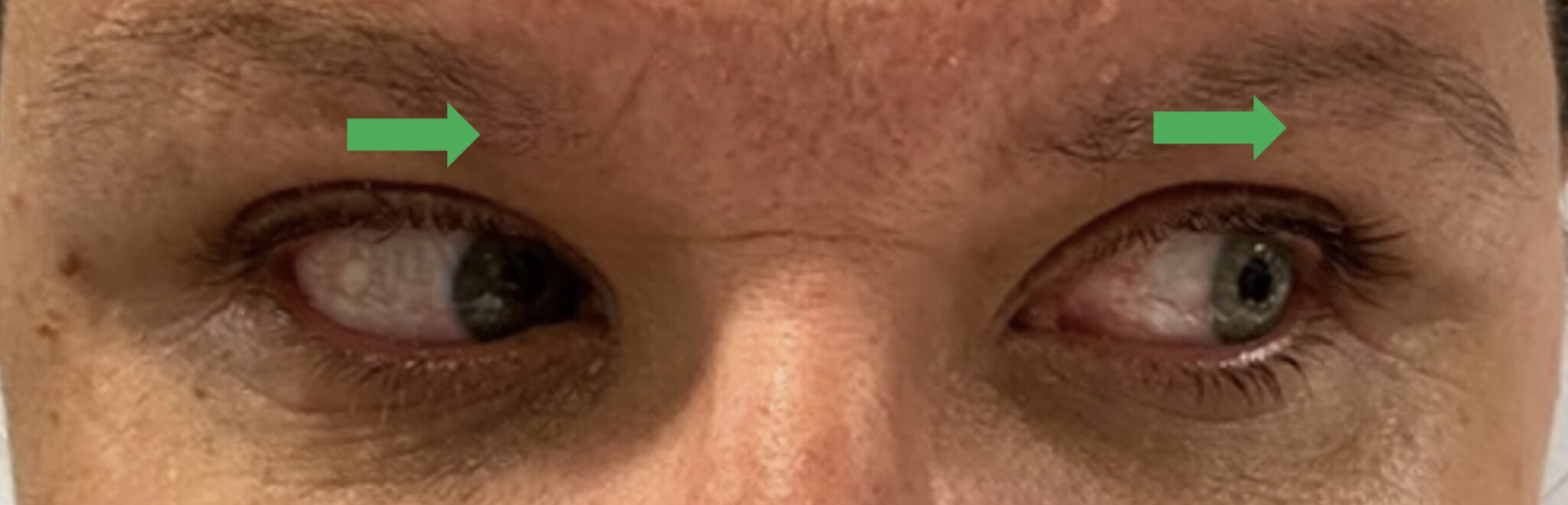 Internuclear Ophthalmoplegia. Eyes Left, Annotated. JETem 2024 - JETem