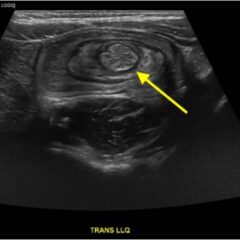 Case Report of a Child with Colocolic Intussusception with a Primary ...