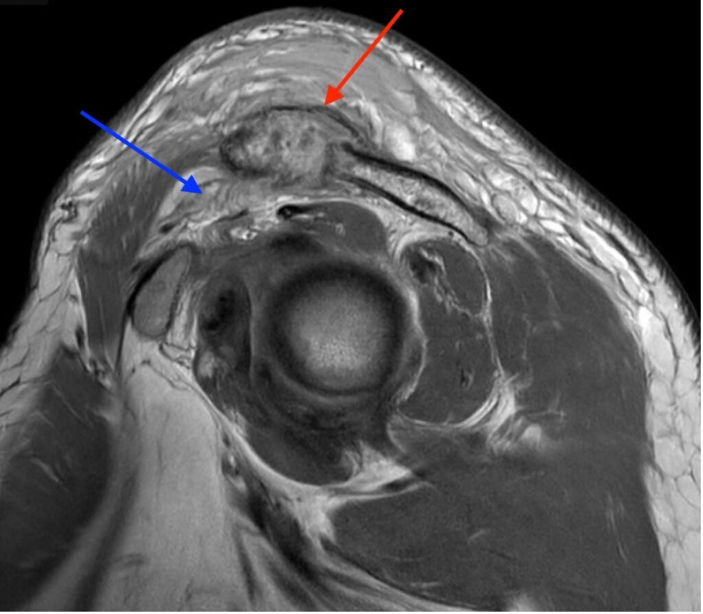 Septic Arthritis of AC Joint. MRI Sagittal. Annotated. JETem 2024 - JETem