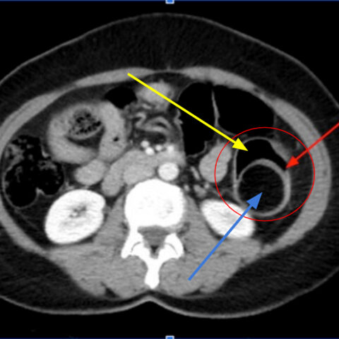 Telescoping into Adulthood: A Case Report of Intussusception in an ...