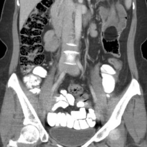 Telescoping into Adulthood: A Case Report of Intussusception in an ...