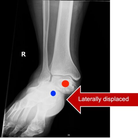 A Case Report of Lateral Subtalar Dislocation: Emergency Medicine ...