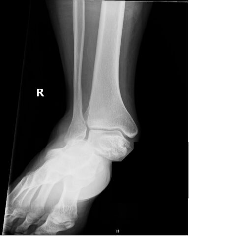 A Case Report of Lateral Subtalar Dislocation: Emergency Medicine ...