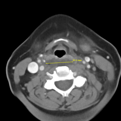Retropharyngeal Abscess in an Adult Patient Presenting with Neck ...