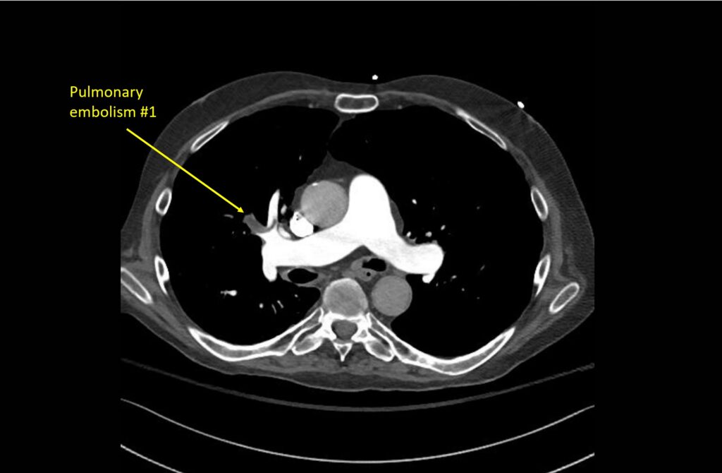 Wolff A, et al. Right atrial thrombosis. CT axial, 1 - JETem