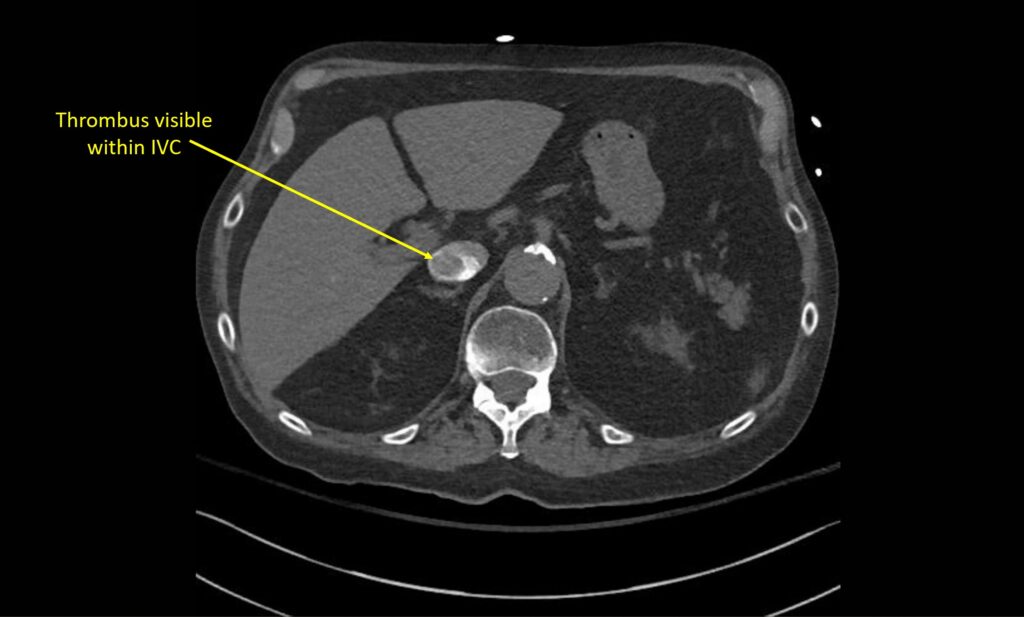 Wolff A, et al. Right atrial thrombosis. CT axial, IVC 1 - JETem