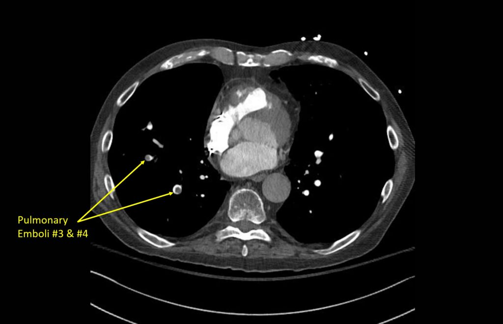Wolff A, et al. Right atrial thrombosis. CT axial, PE 3 - JETem