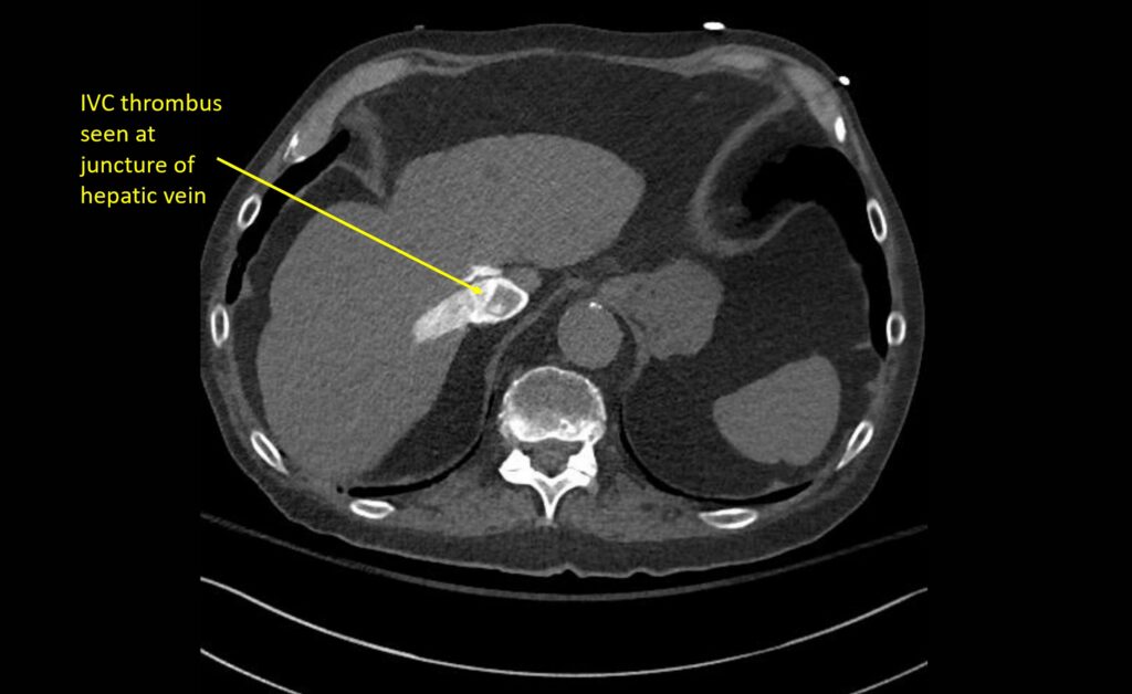 Wolff A, et al. Right atrial thrombosis. CT axial, juncture of hepatic ...