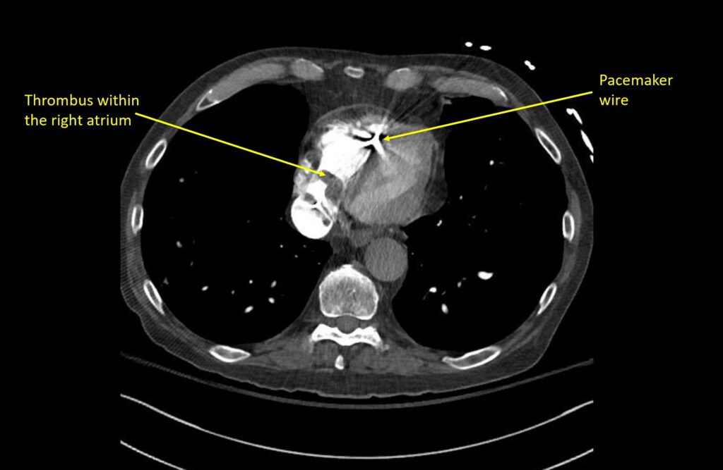 Wolff A, et al. Right atrial thrombosis. CT axial, right atrium - JETem
