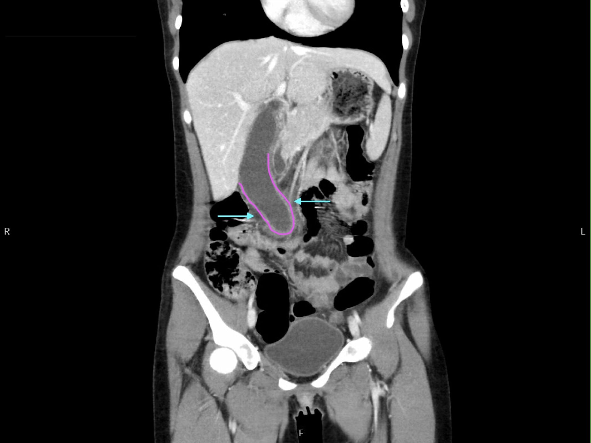 Hydropic Gallbladder. CT, Coronal, Annotated. JETem 2025 - JETem