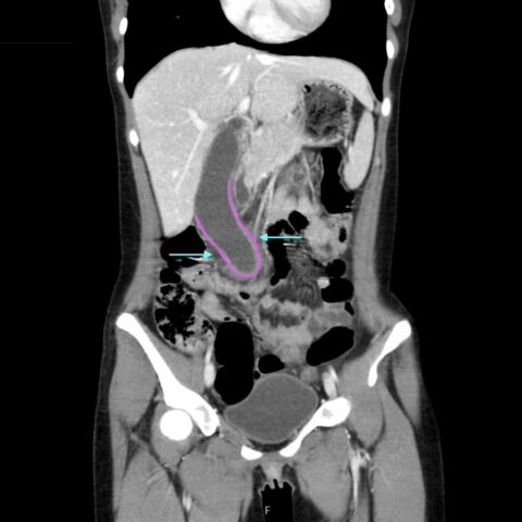 A Case Report of Hydropic Gallbladder Presenting as Right Lower ...