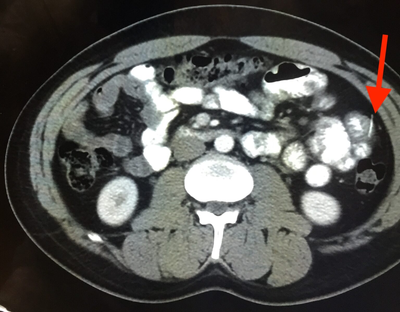 Iatrogenic Bowel Perforation Following Dental Procedure. CT. Annotated ...