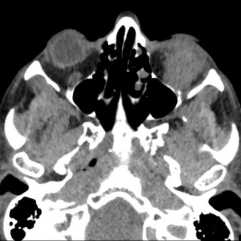 A Case Report of Inferior Rectus Abscess - JETem