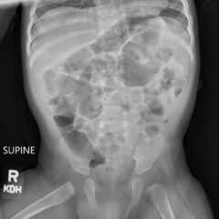Case Report of Incarcerated Gastric Volvulus and Splenic Herniation in ...