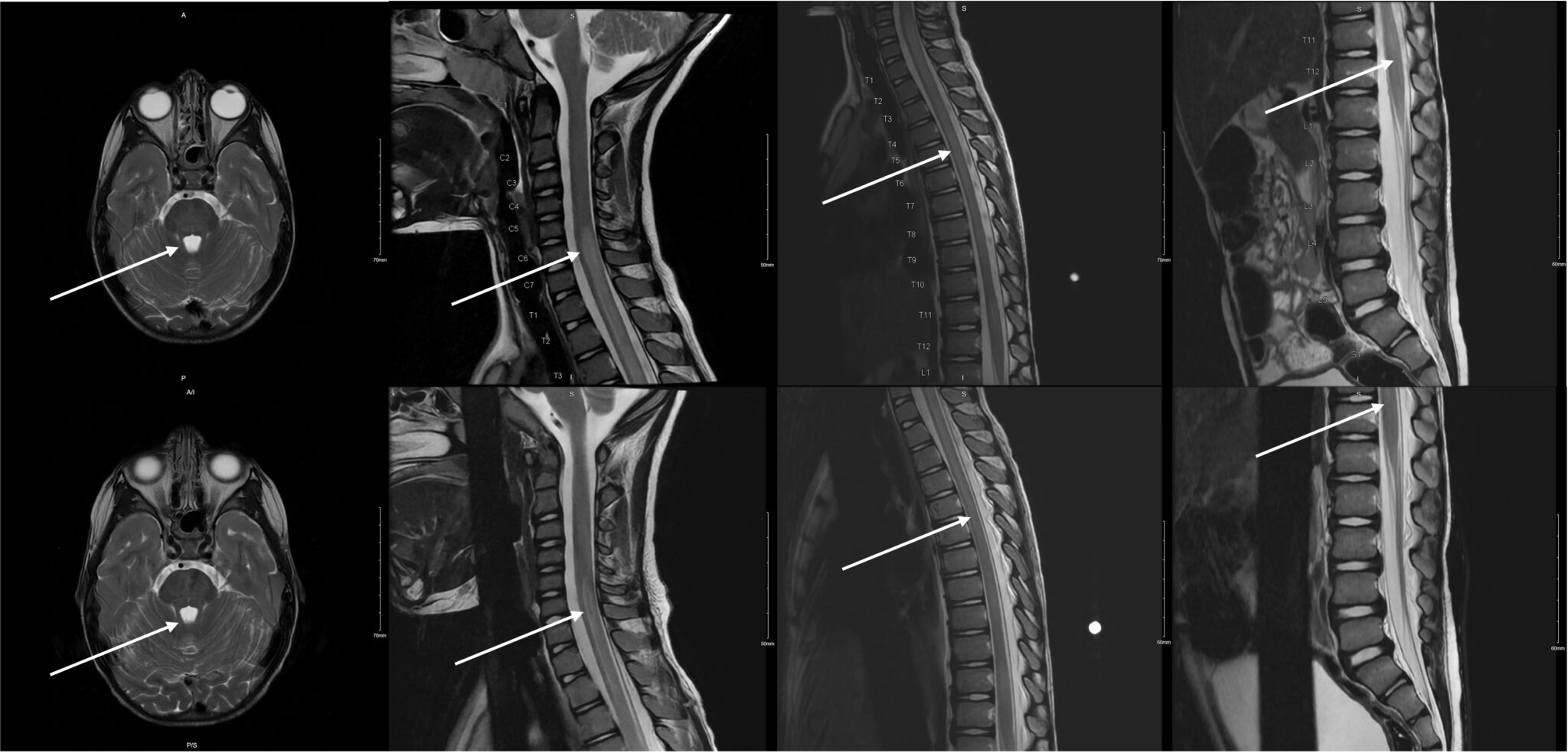 Mycoplasma Associated Acute Transverse Myelitis. MRI. Annotated. JETem ...