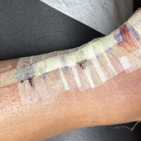 Case Report of a Dermatologic Reaction to Wound Closure Strips and ...
